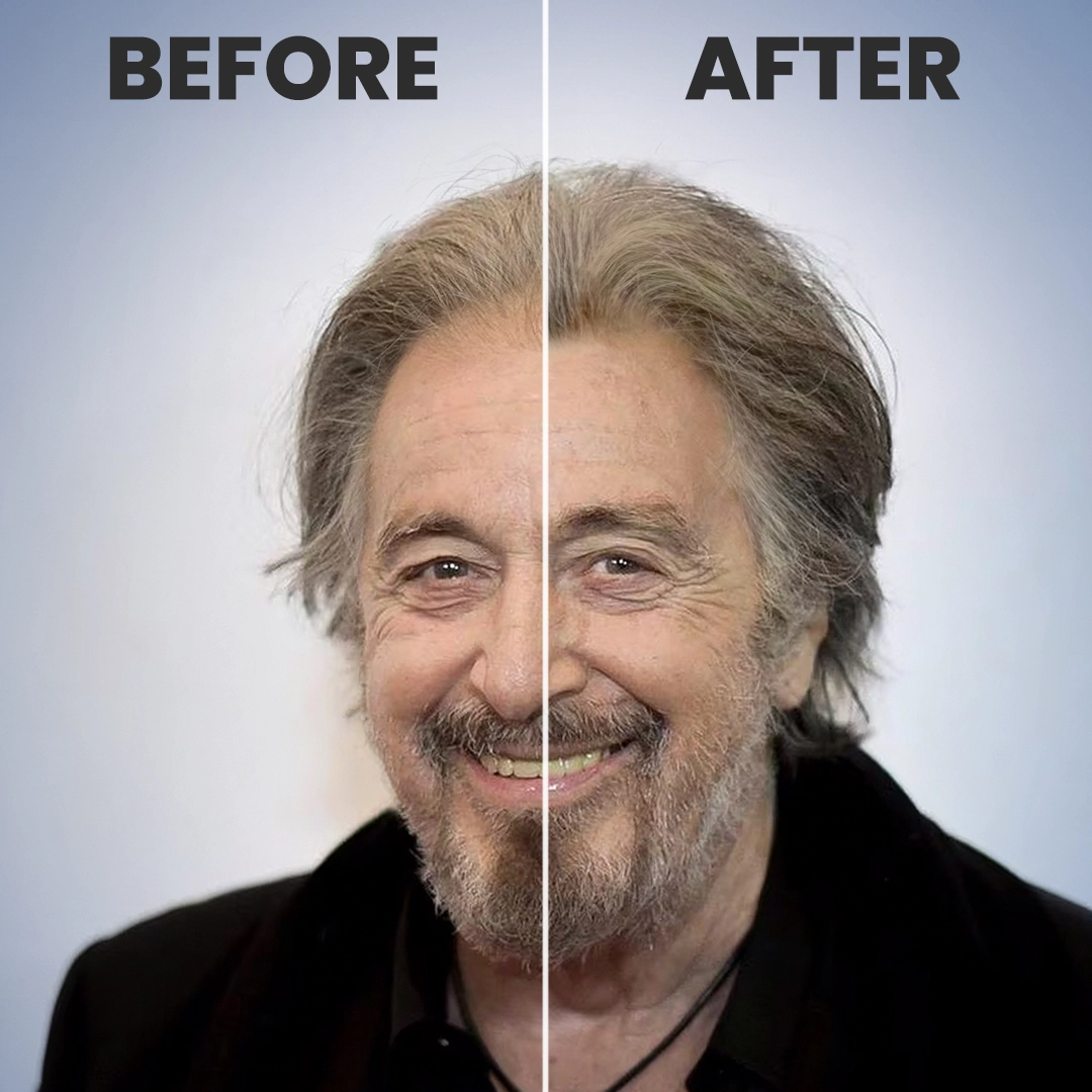 Al Pacino Hair Transplant Simulation