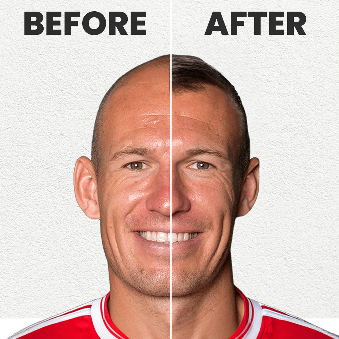 Arjen Robben With Hair | Hair Transplant Simulation Result