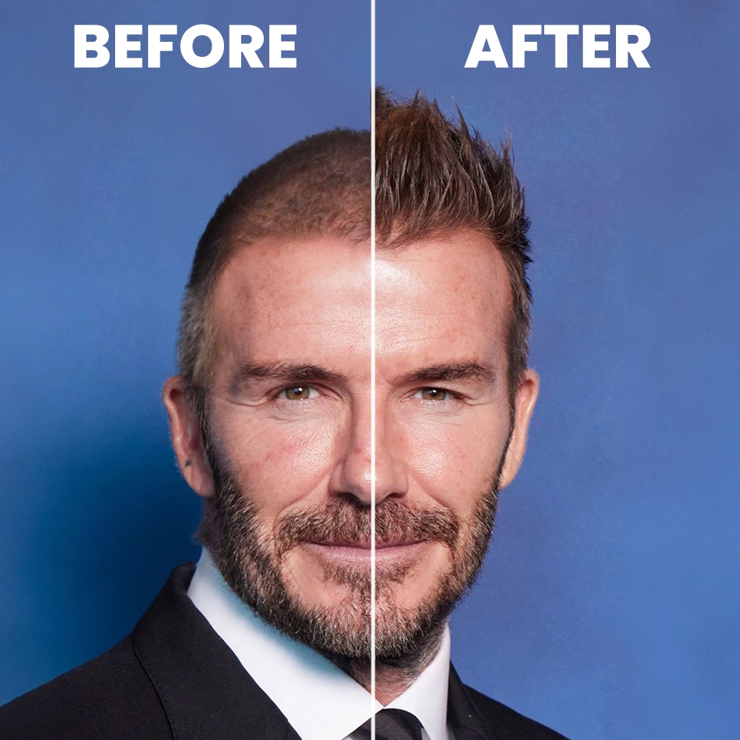 David Beckham Before And After Plastic Surgery
