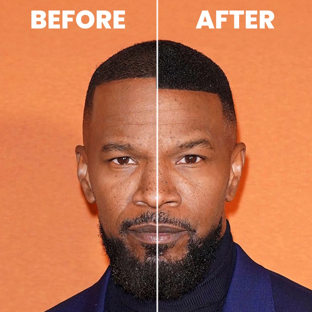 Jamie Foxx Hair Transplant Simulation