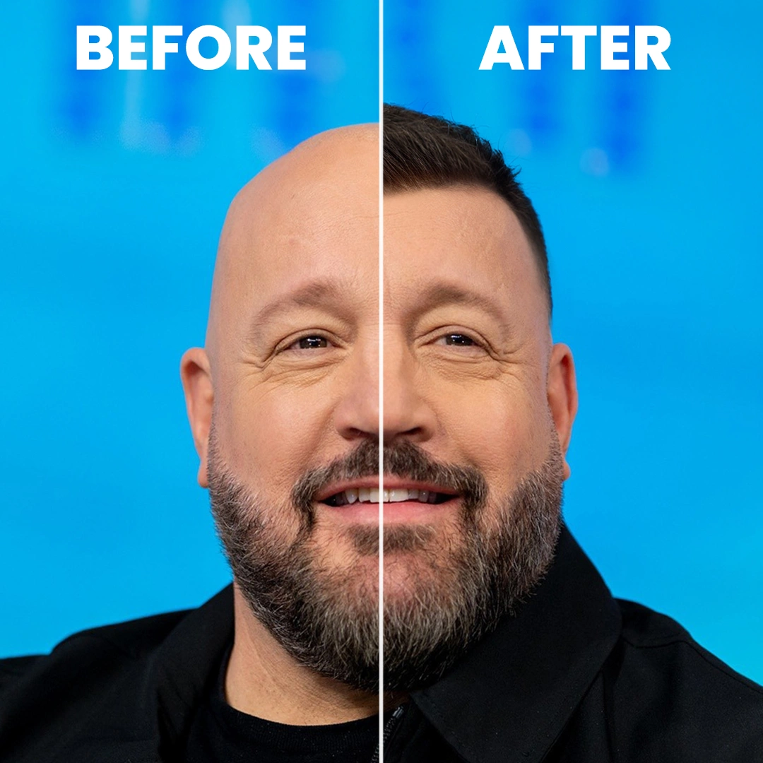 Should Kevin James Get a Hair Transplant? Pros and Cons