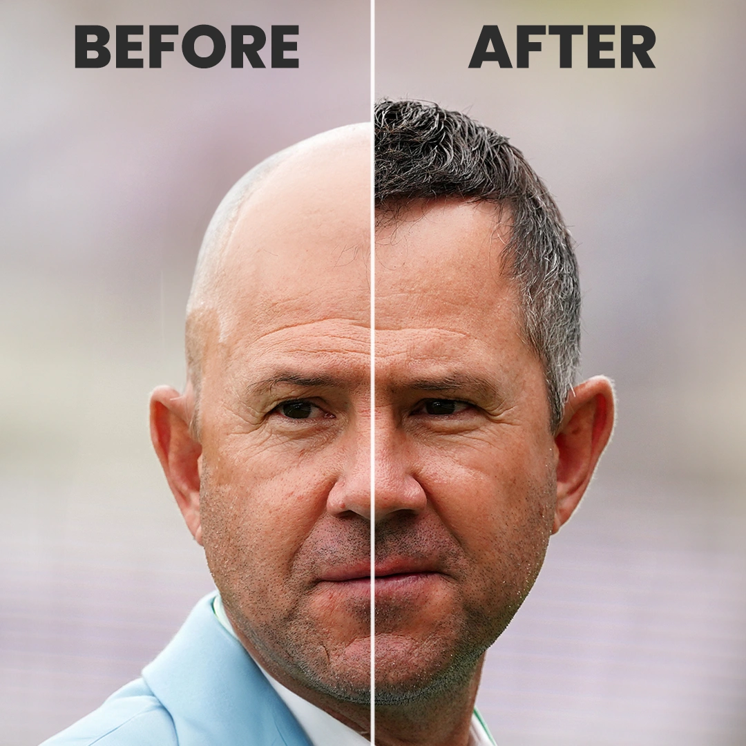 Ricky Ponting Hair Transplant: Did the Cricket Legend Restore His Hairline?