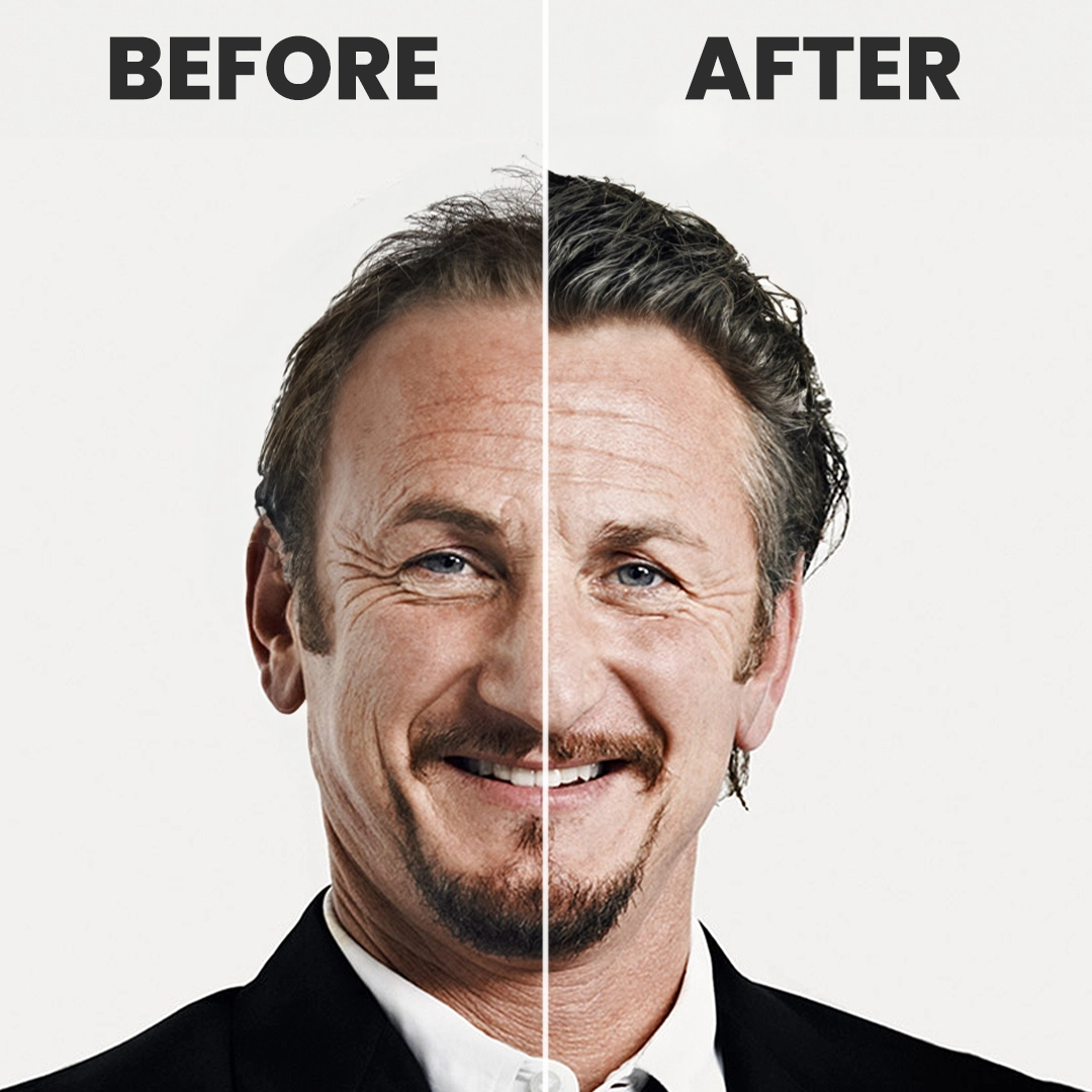 Sean Penn Hair Transplant: Did He Enhance His Look?
