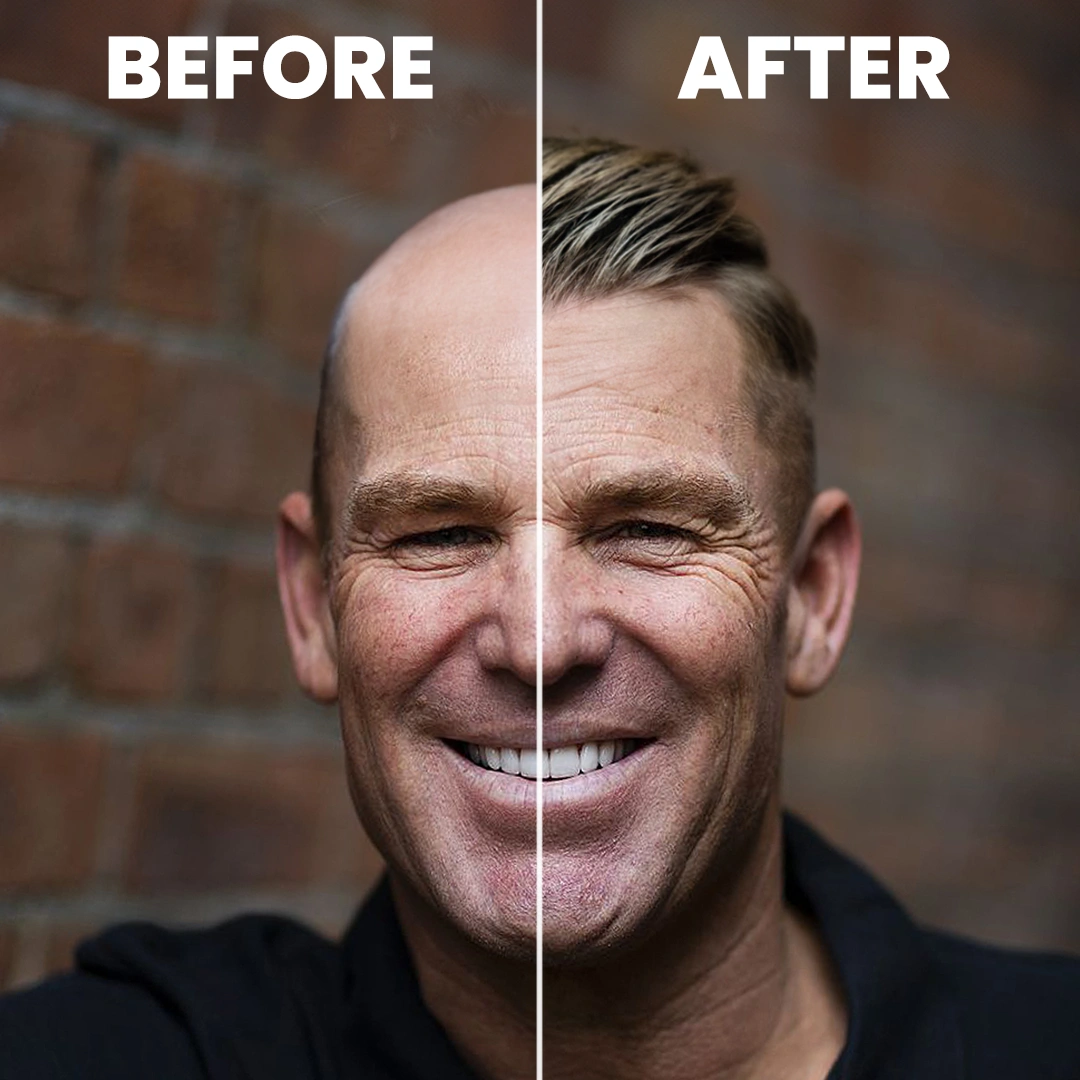 Shane Warne Hair Transplant: The Legendary Cricketer’s Hair Restoration ...