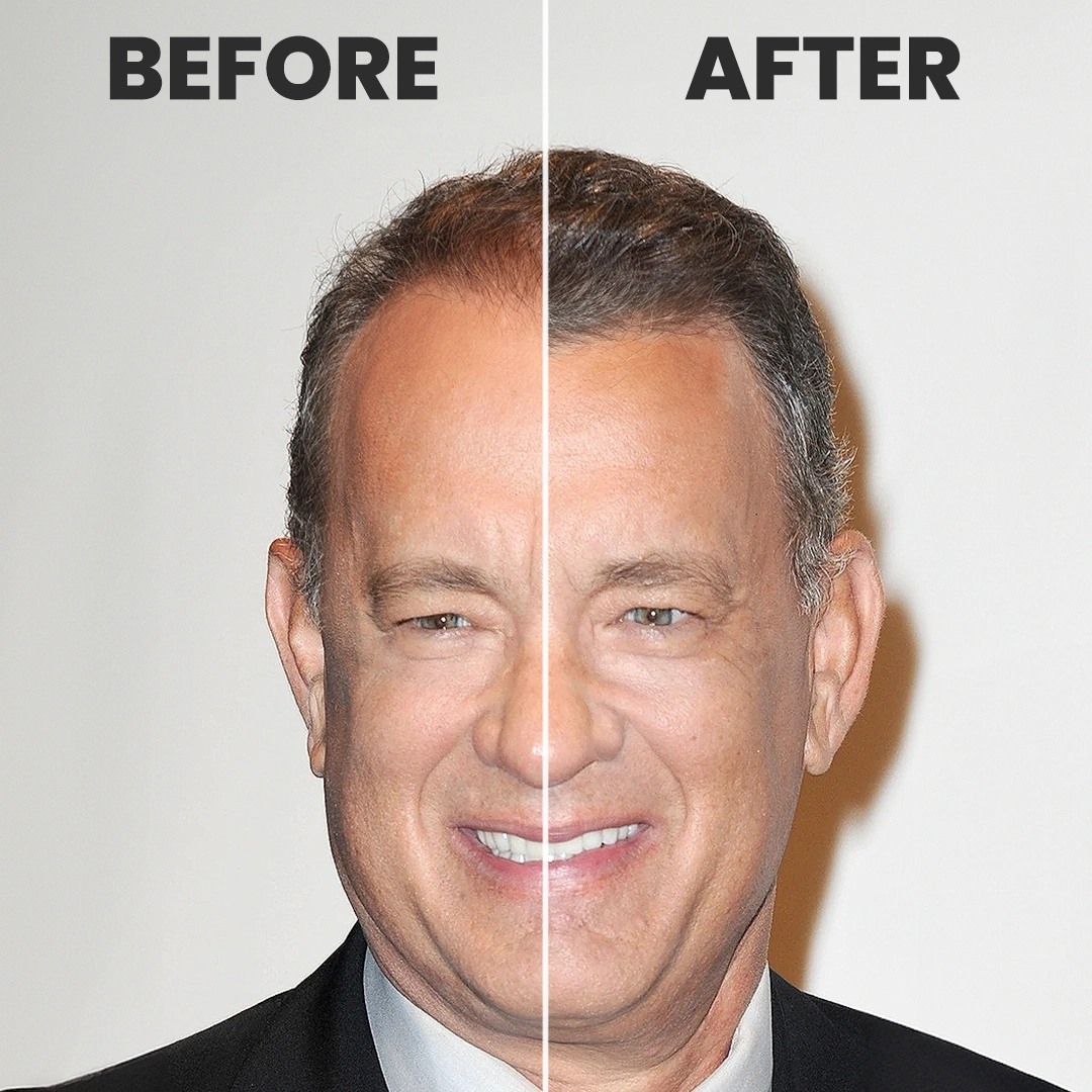 Tom Hanks Hair Transplant: Should He Get One or Not?