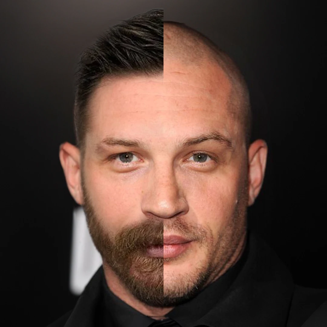 Tom Hardy With Hair | Hair Transplant Simulation Result